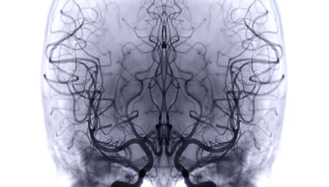 Lower Diagnostic Success With Transradial Cerebral Angiography | tctmd.com